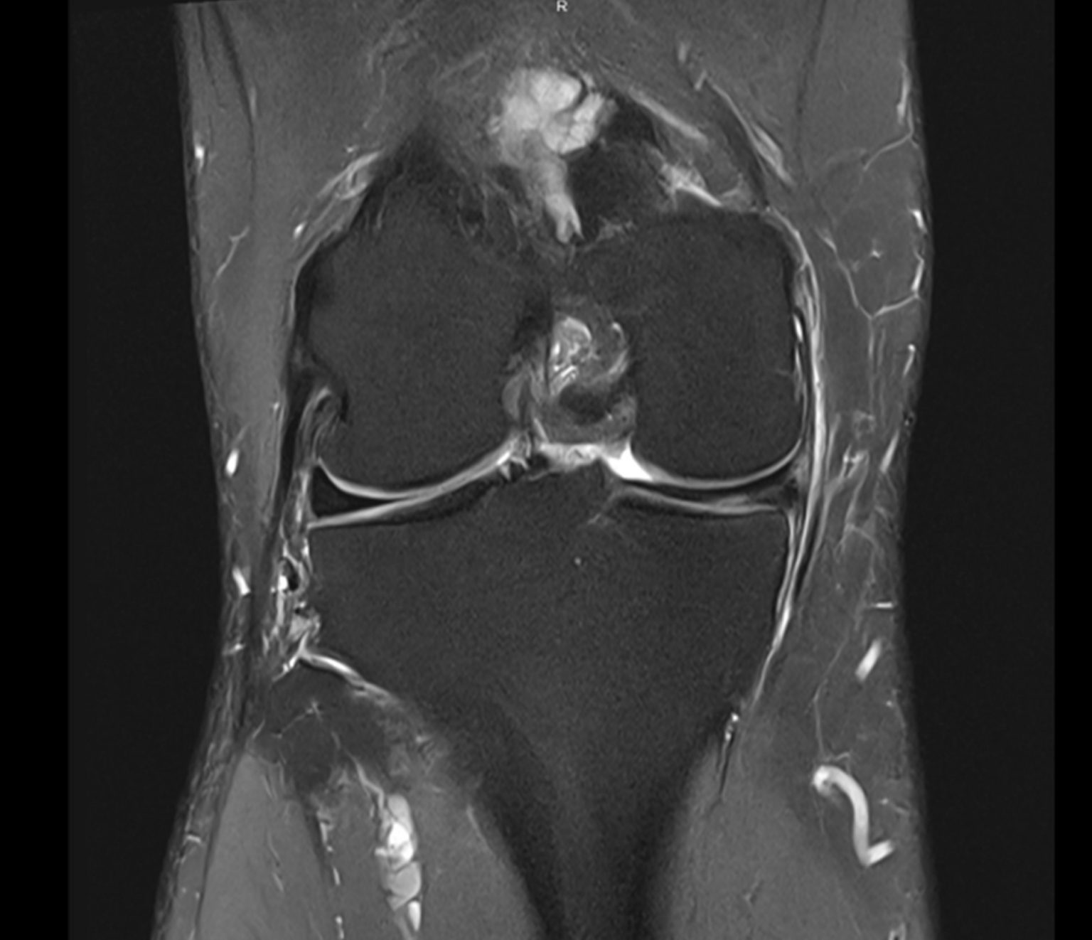 Meniskusschaden (Meniskopathie) - ORTHO | MOVE